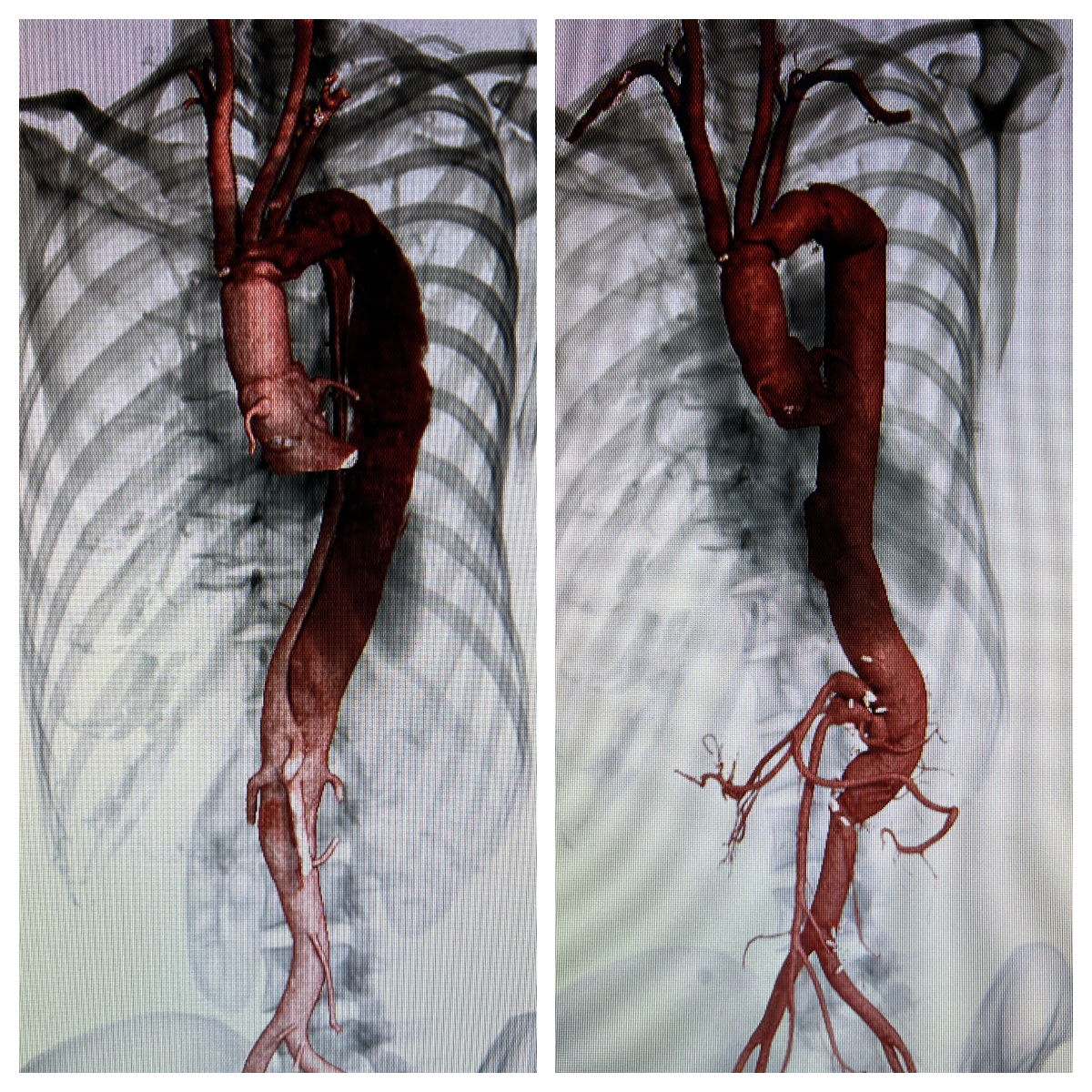 Young Patient Reflects on ‘Whirlwind’ Diagnosis to the Novel Heart ...